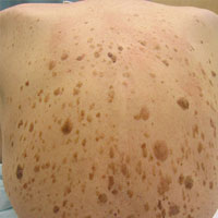 Melasma Treatment in San Jose - How to Treat Melasma | Dr. Rani MD